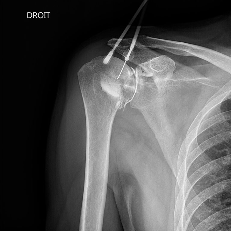 Traitement par infiltration – Imagerie Médicale Jules Verne Amiens