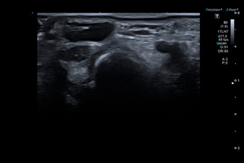 Traitement par infiltration – Imagerie Médicale Jules Verne Amiens